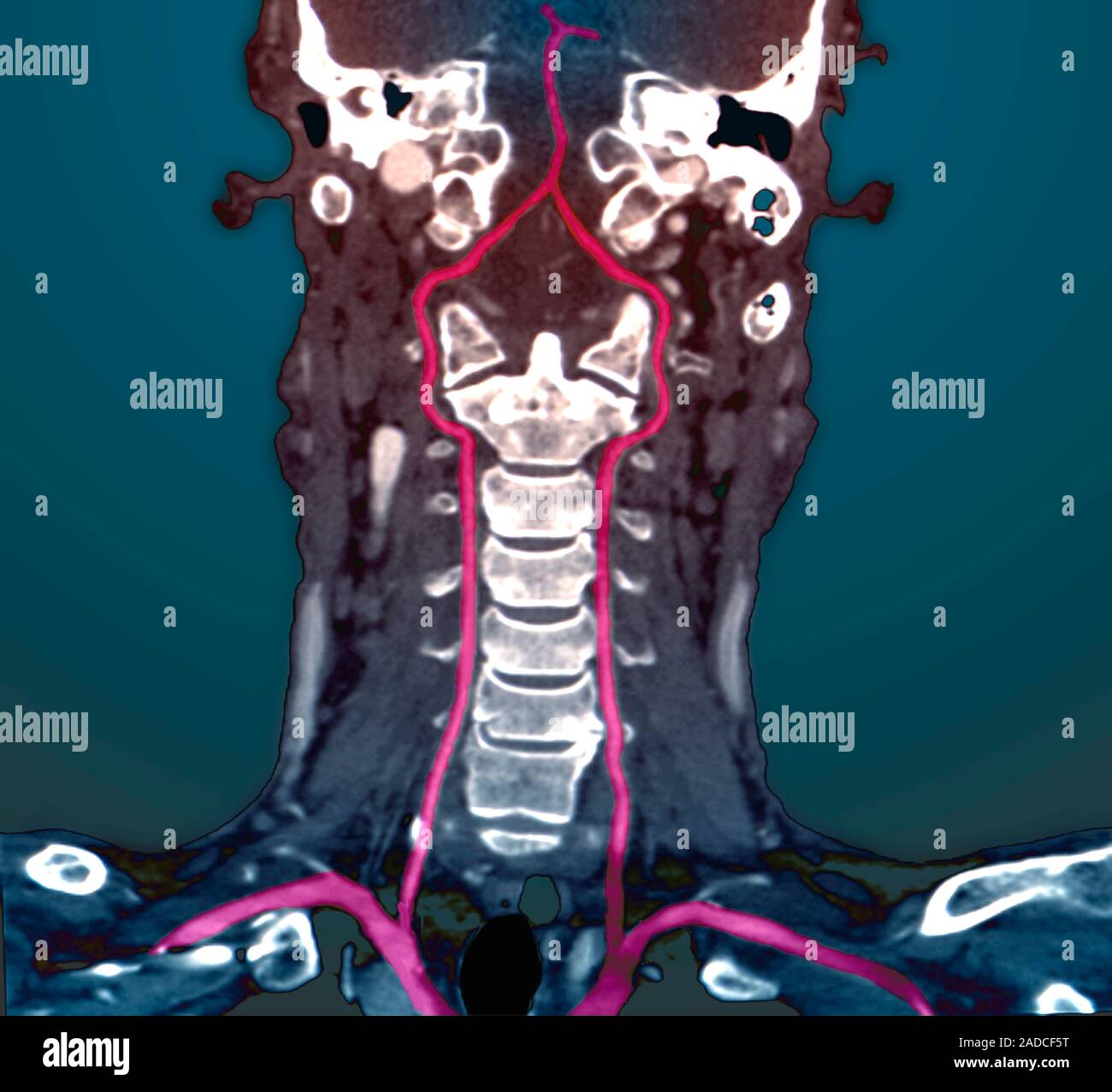 Neck arteries and spine. Coloured coronal computed tomography (CT ...