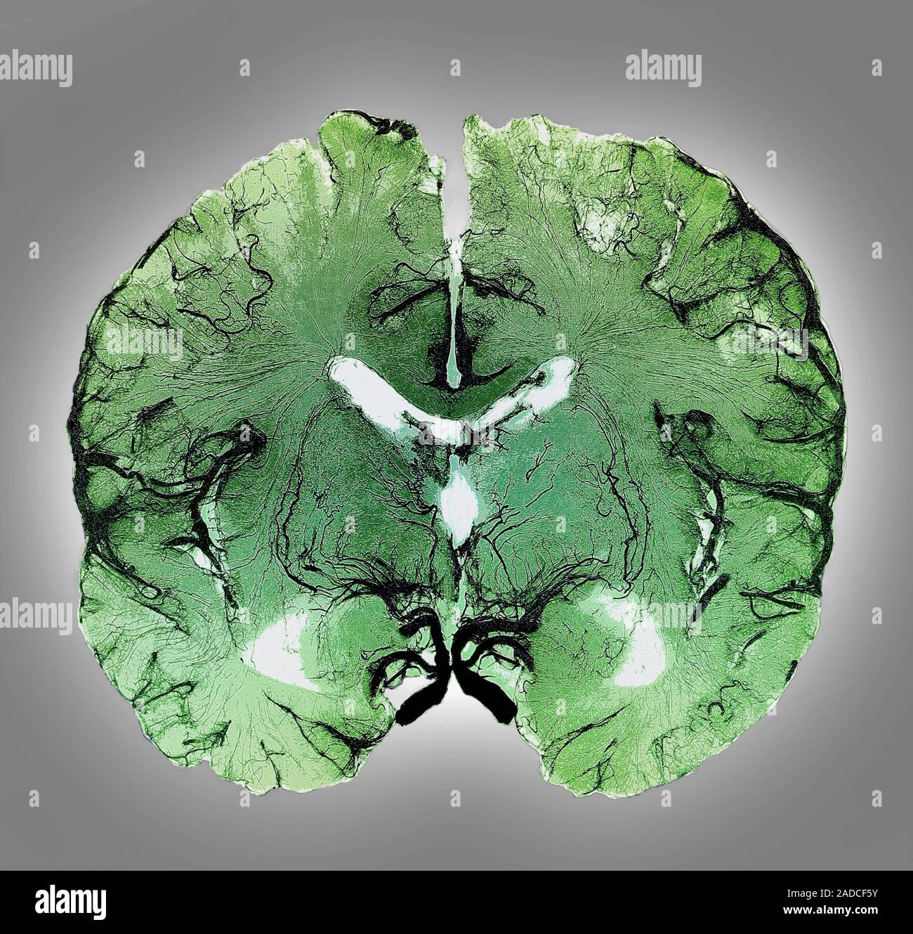 Coronal brain slice specimen. This specimen was prepared by the ...