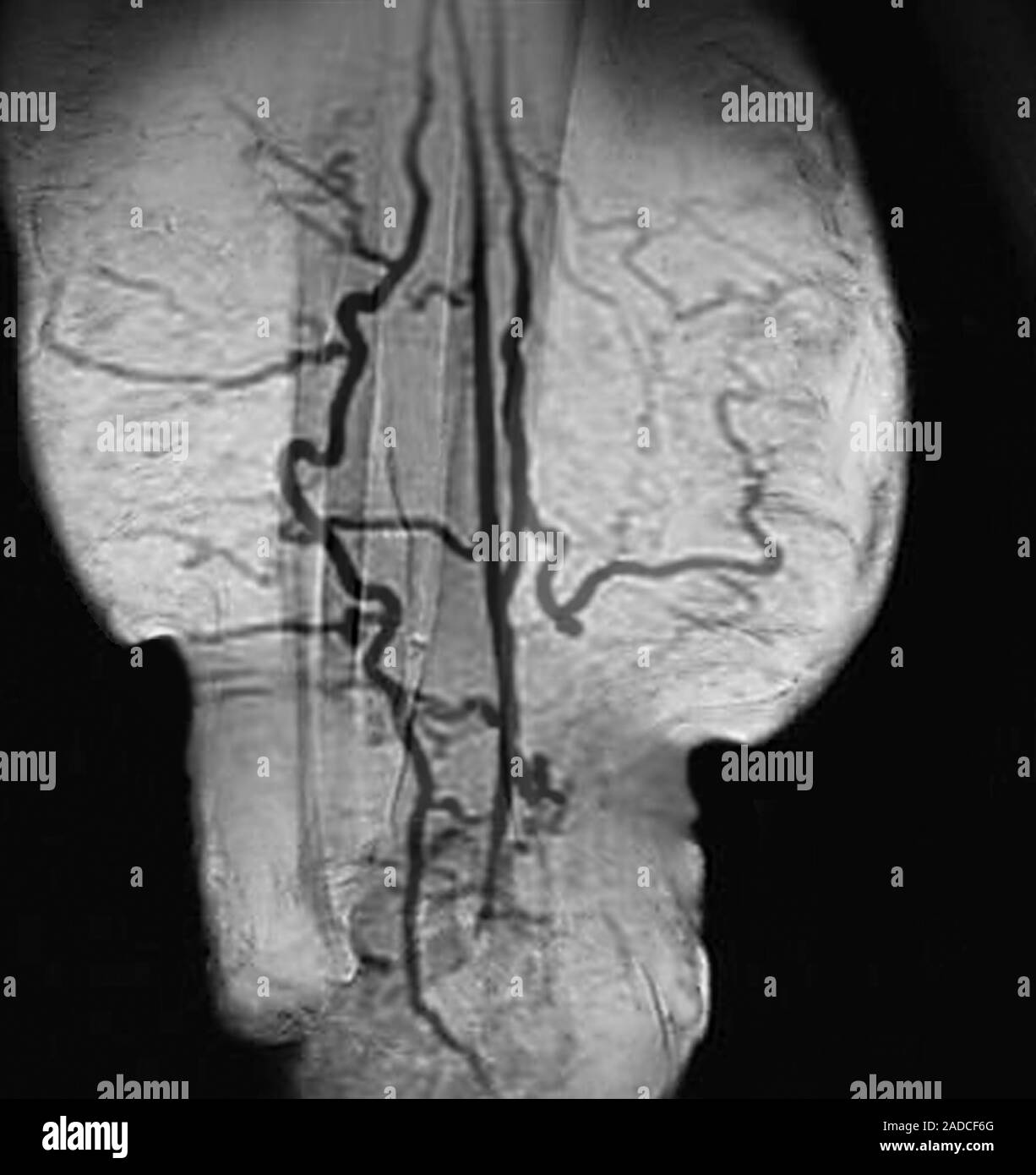 Elephantiasis of the legs. Magnetic resonance angiography (MRA) scan of ...