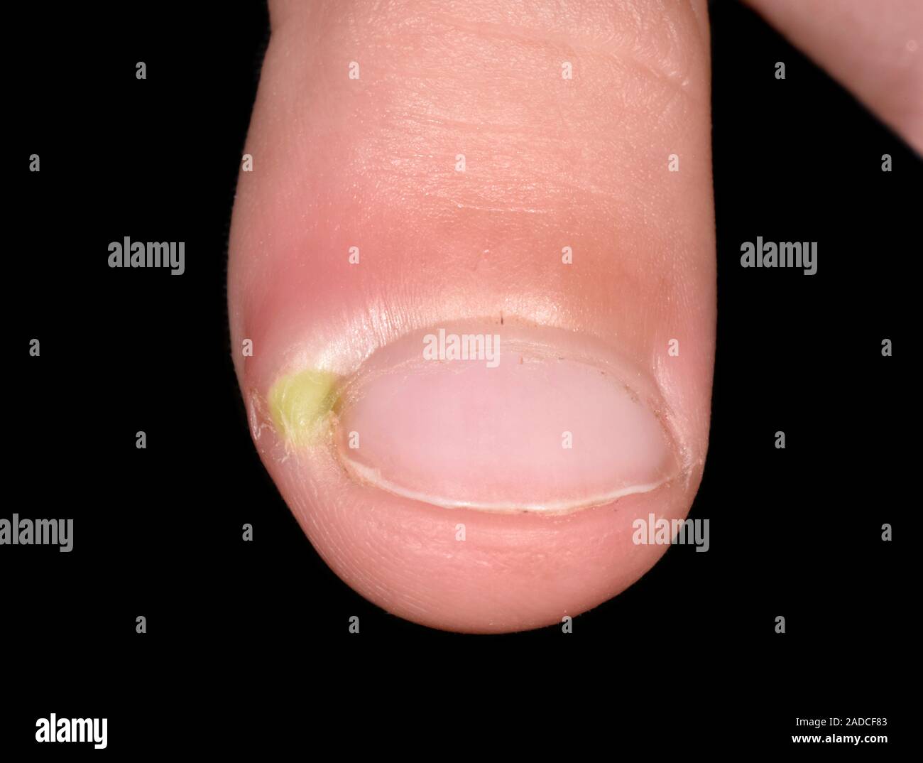Paronychia infection of the thumb. Close-up of the thumb of a 7-year ...