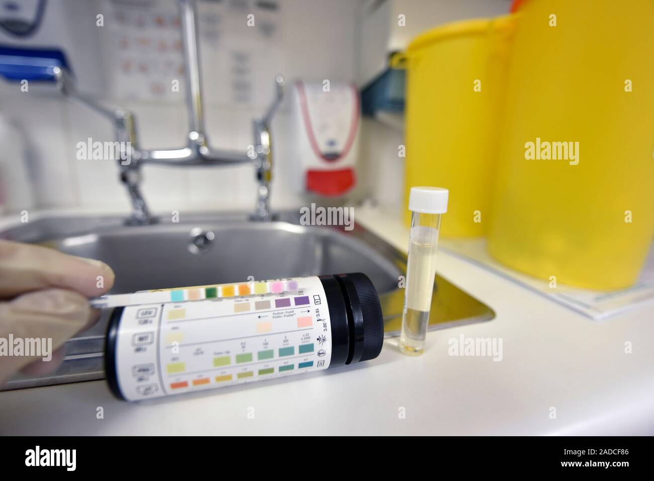 Urine test in urinary tract infection. The test identifies signs of ...