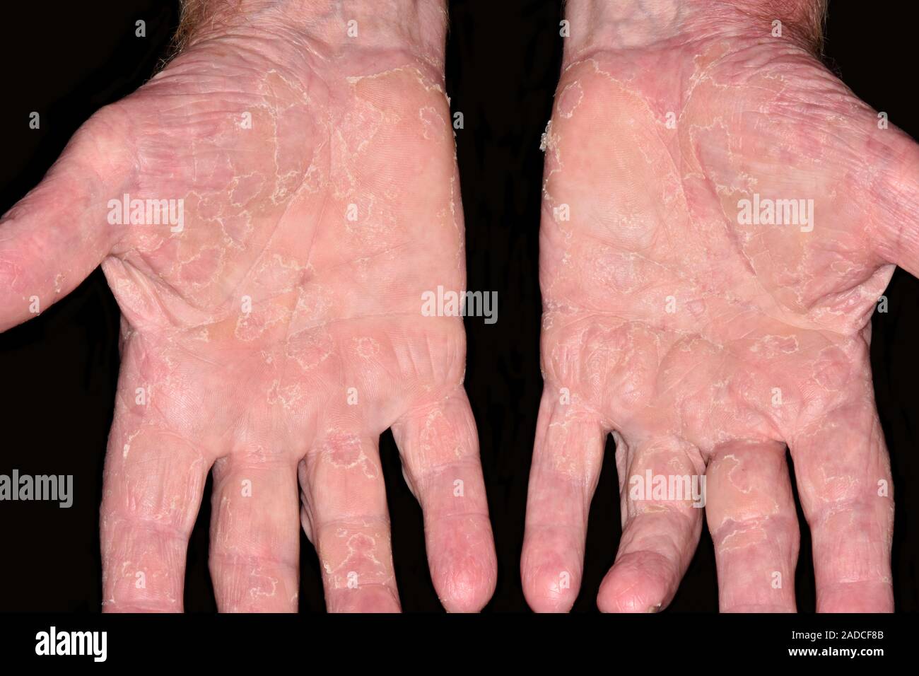 Acute dermatitis. Close-up of desquamation (peeling skin) on the hands ...