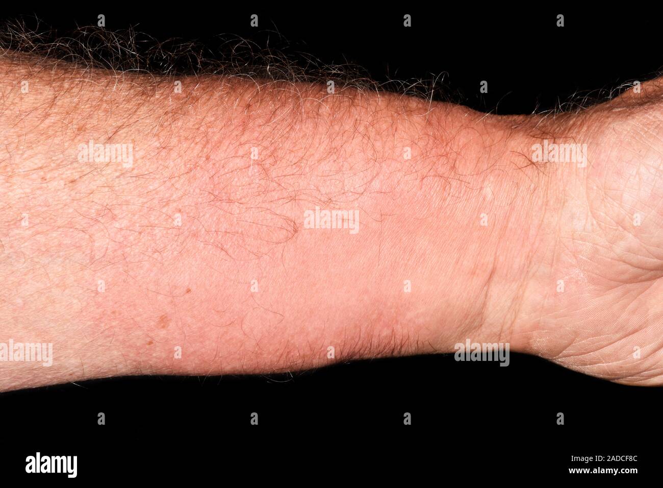 Wasp sting. Swelling in the forearm of a 75-year-old man caused by a ...
