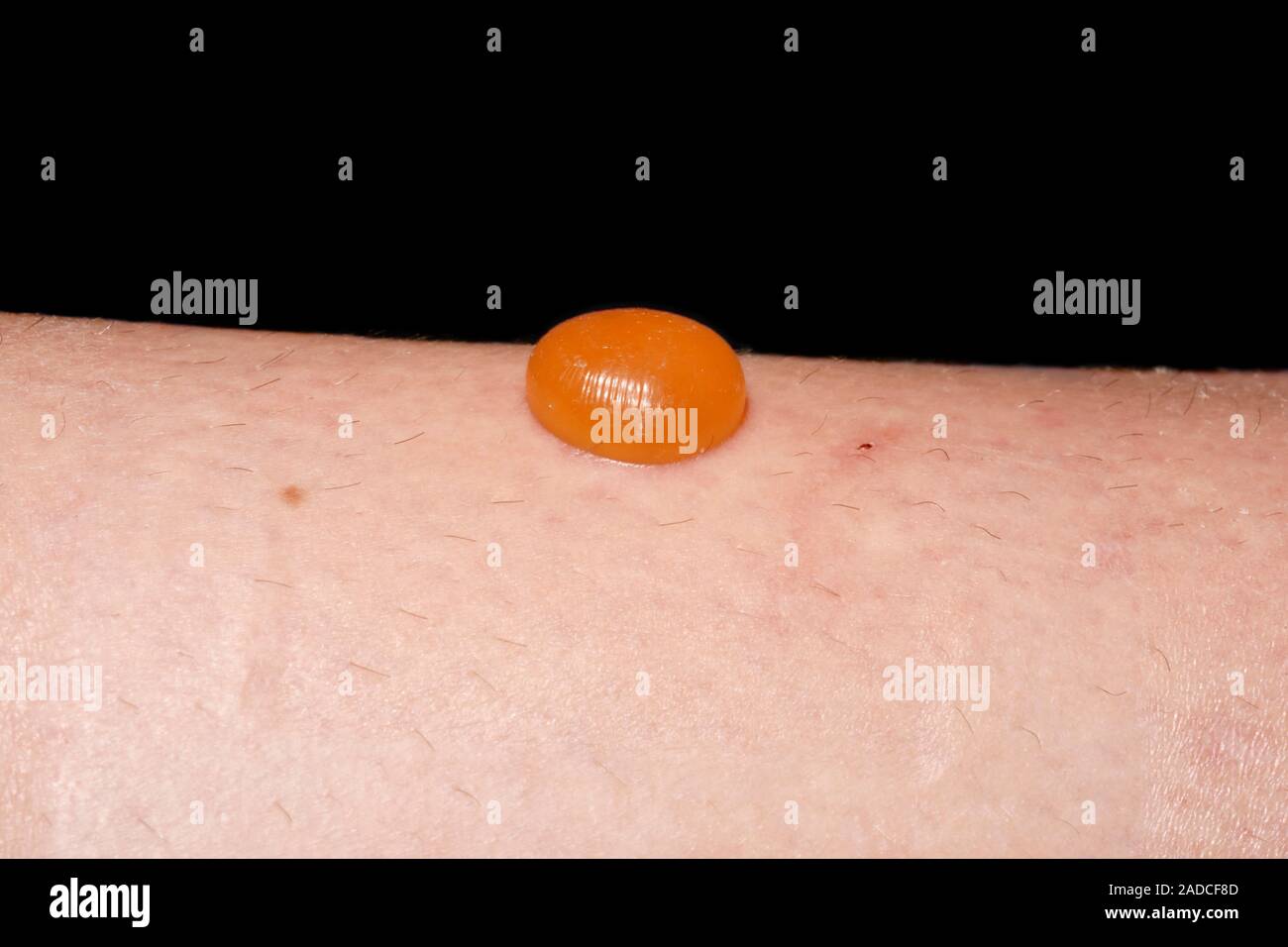 Insect bite allergy. Blister on the skin of a 17-year-old girl, an ...
