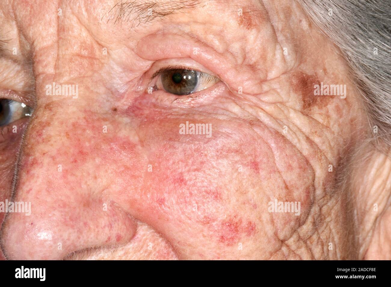 Angioedema. Close-up of the face and eyes of a 89-year-old female ...
