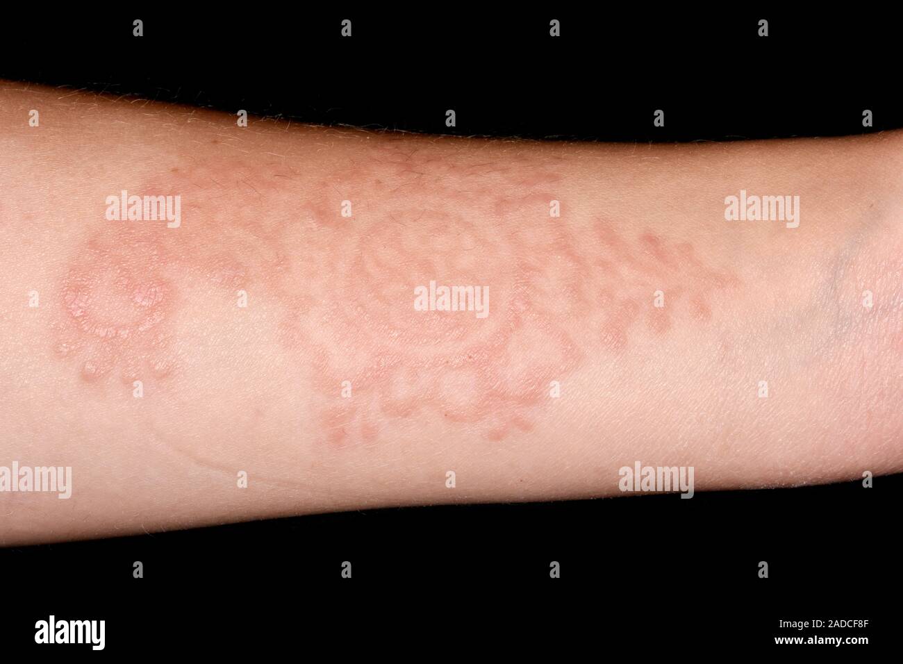 Allergic reaction to henna tattoo. Close-up of the reddened arm of a 12 ...