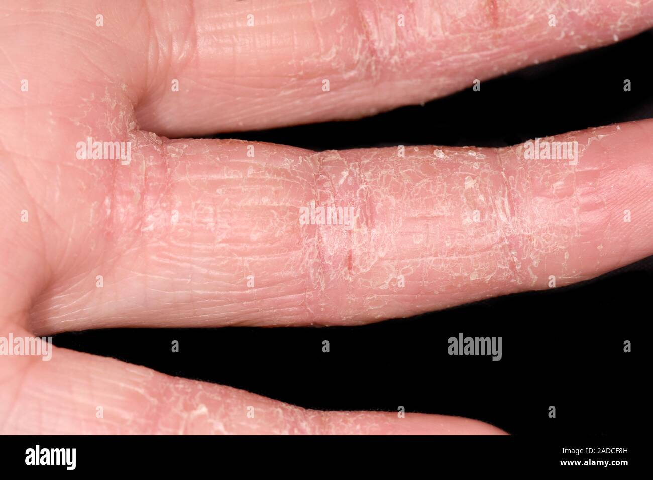 Eczema. Close-up of inflamed skin on the fingers of a 12-year-old girl ...