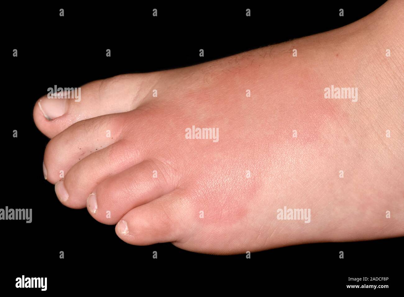 Wasp sting. Swelling and reddening of the foot of a 11-year-old boy ...