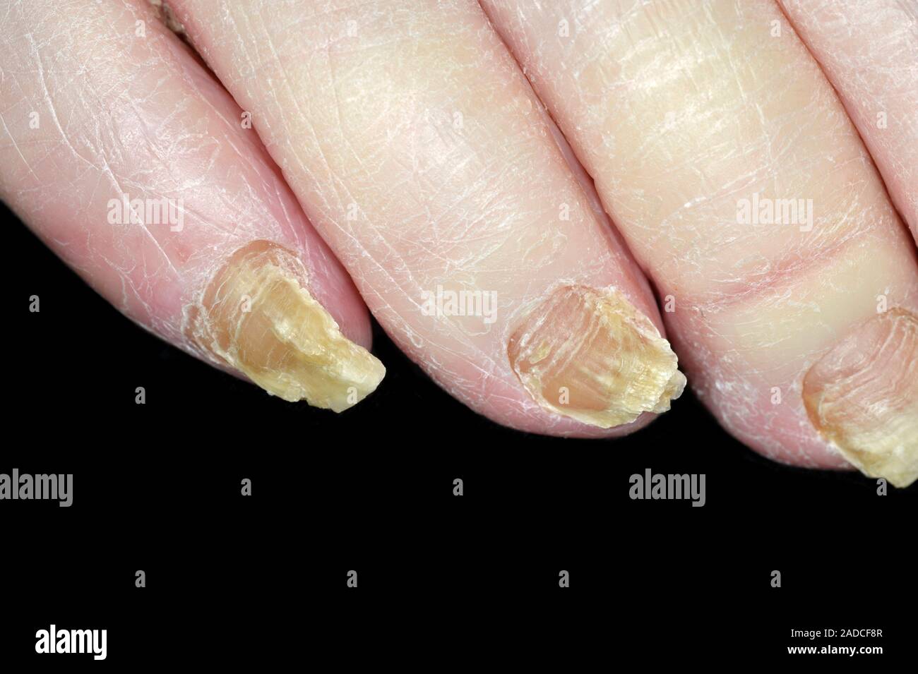 Fungal nail infection. Toenails of a 68-year-old man with onychomycosis ...