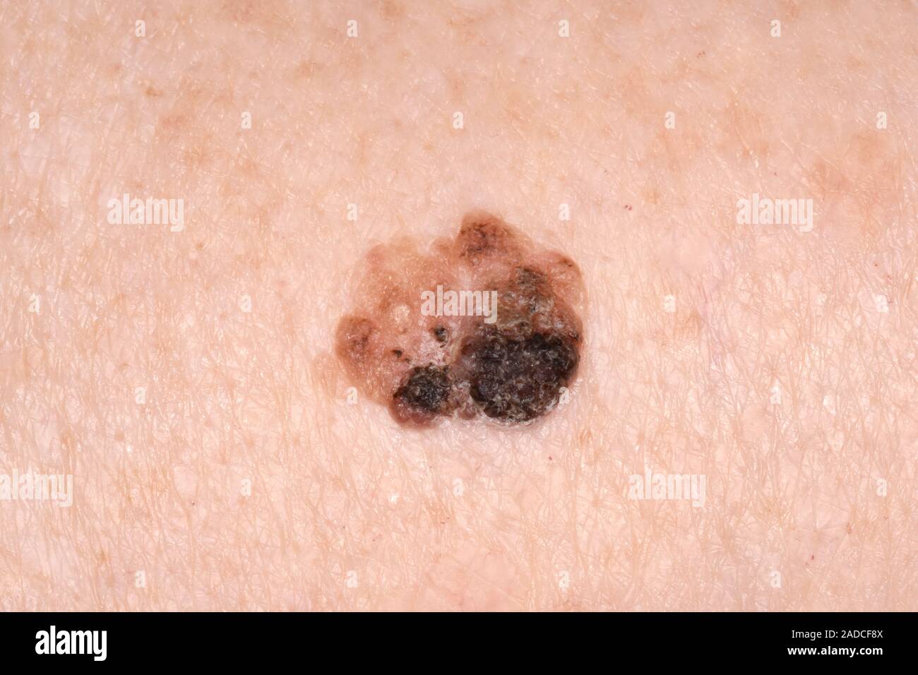 Seborrheic Keratosis Close Up Of A Seborrheic Keratosis Seborrheic Or