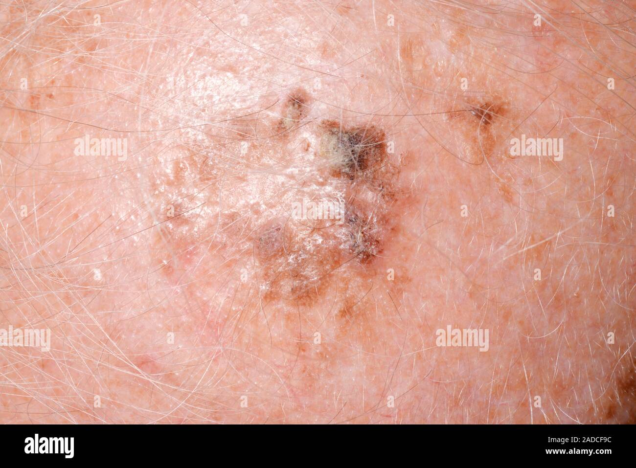 Seborrheic keratosis. Close-up of a seborrheic keratosis (seborrheic or ...