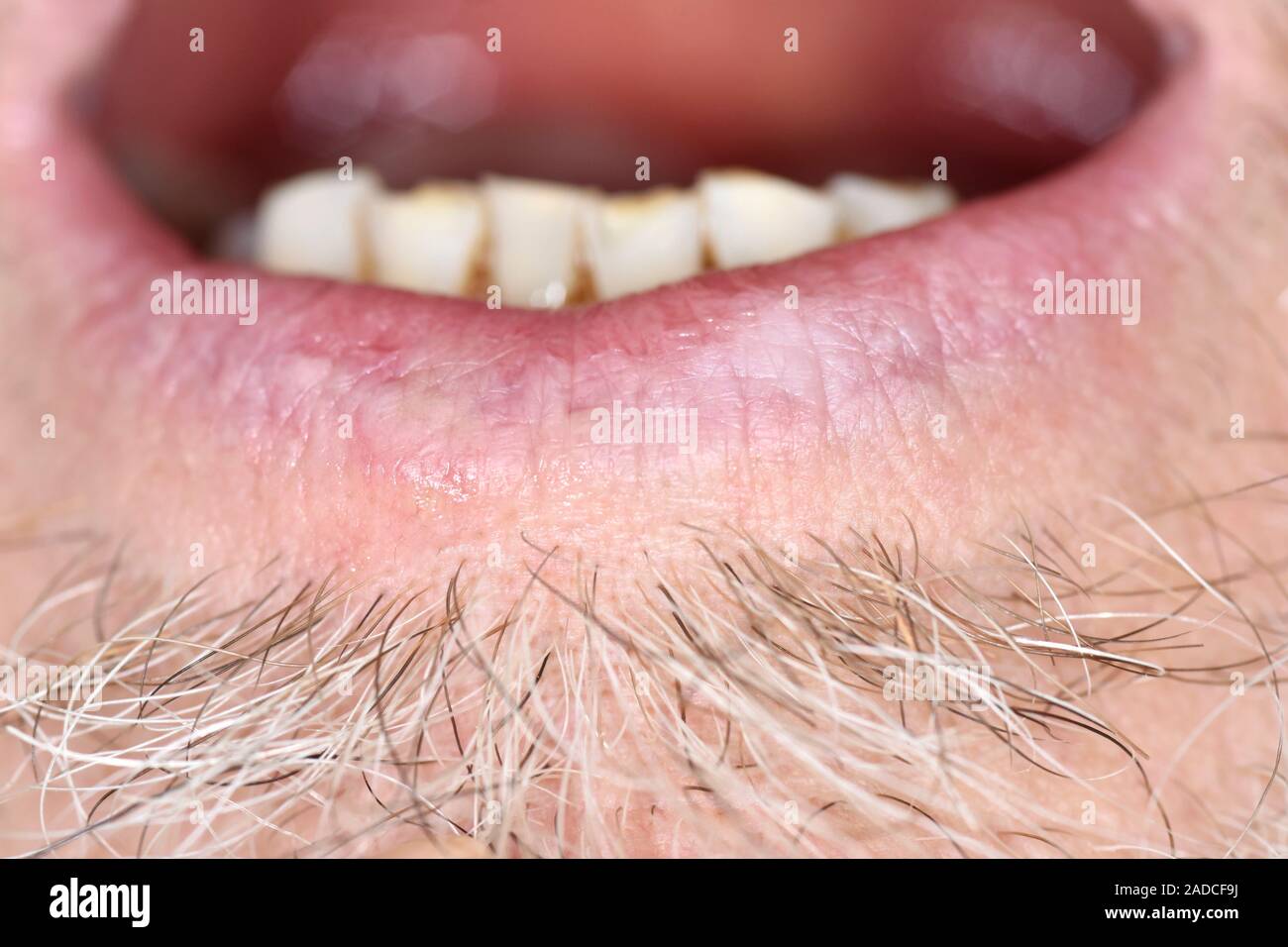Actinic cheilitis (also known as actinic cheilosis, actinic keratosis ...