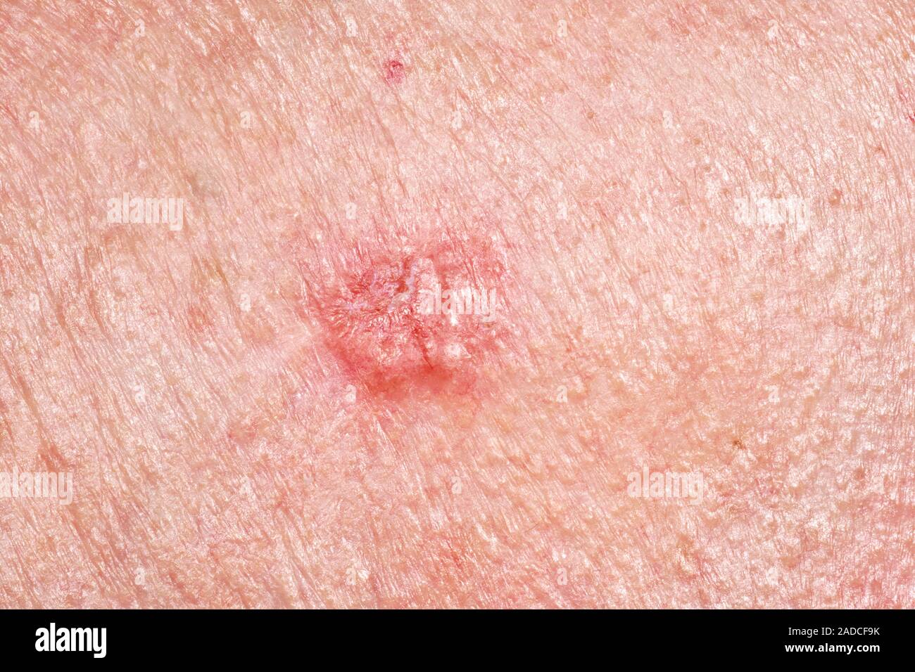 Bowenoid Keratosis Close Up Of A Lesion On The Head Of A 69 Year Old Male Patient Affected By