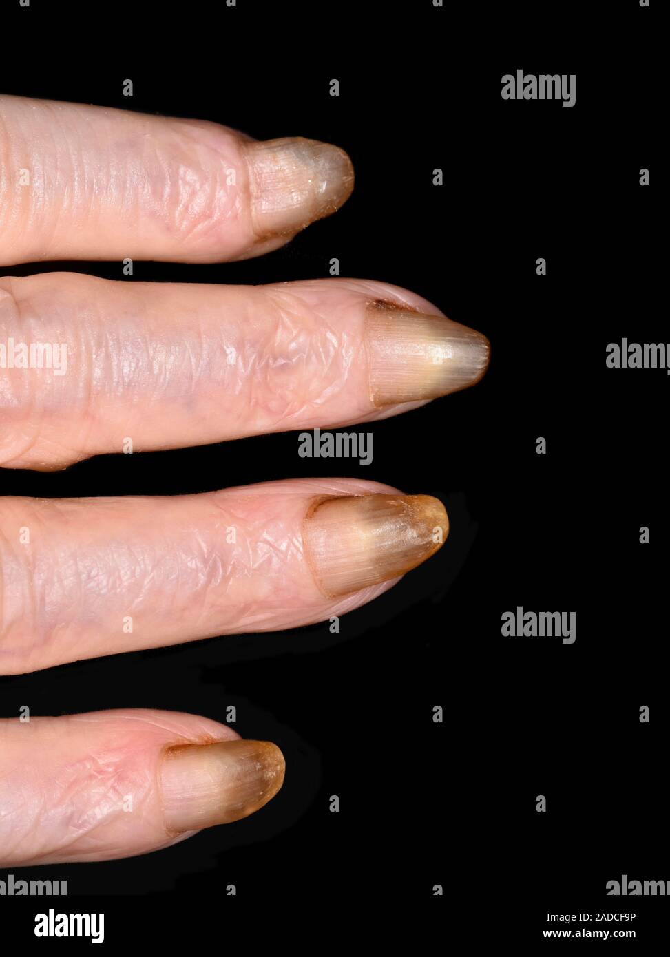 Pachyonychia congenita affecting the fingernails of a 95-year-old man ...