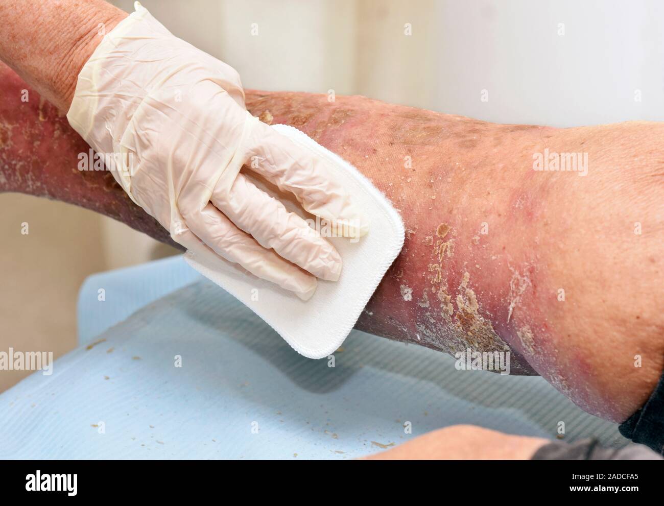 Debridement of skin lesions. A debridement pad being used to remove dead, damaged, or infected ...