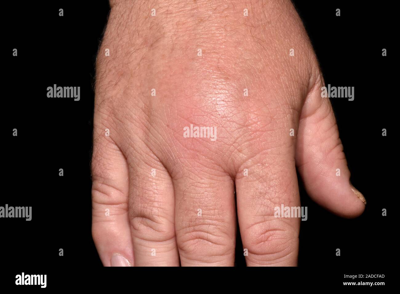 Gout of the metacarpophalangeal (MCP) joint of a 54-year-old man. Gout ...