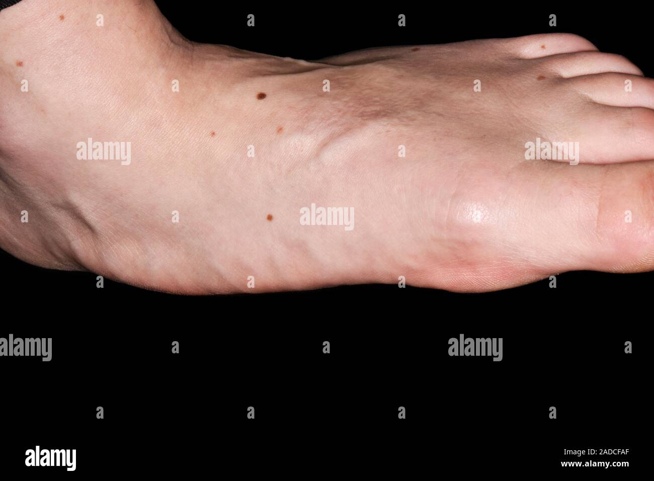 Flat foot. Close-up of the flat foot of a 20-year-old woman. Flat feet ...