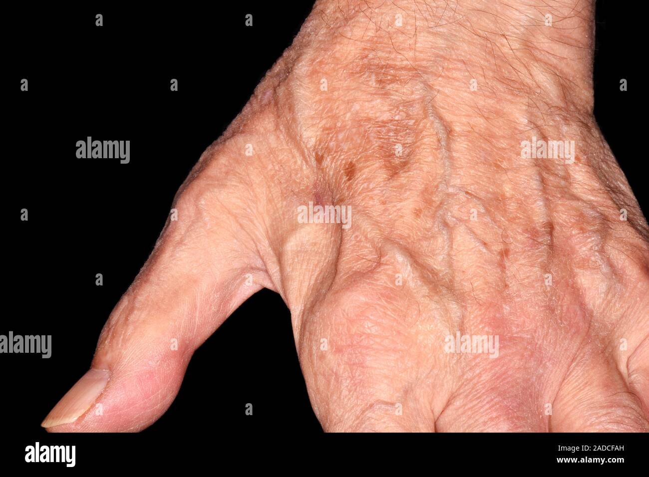 Wasting of the muscles of the hand in a 82 year old man due to carpal ...