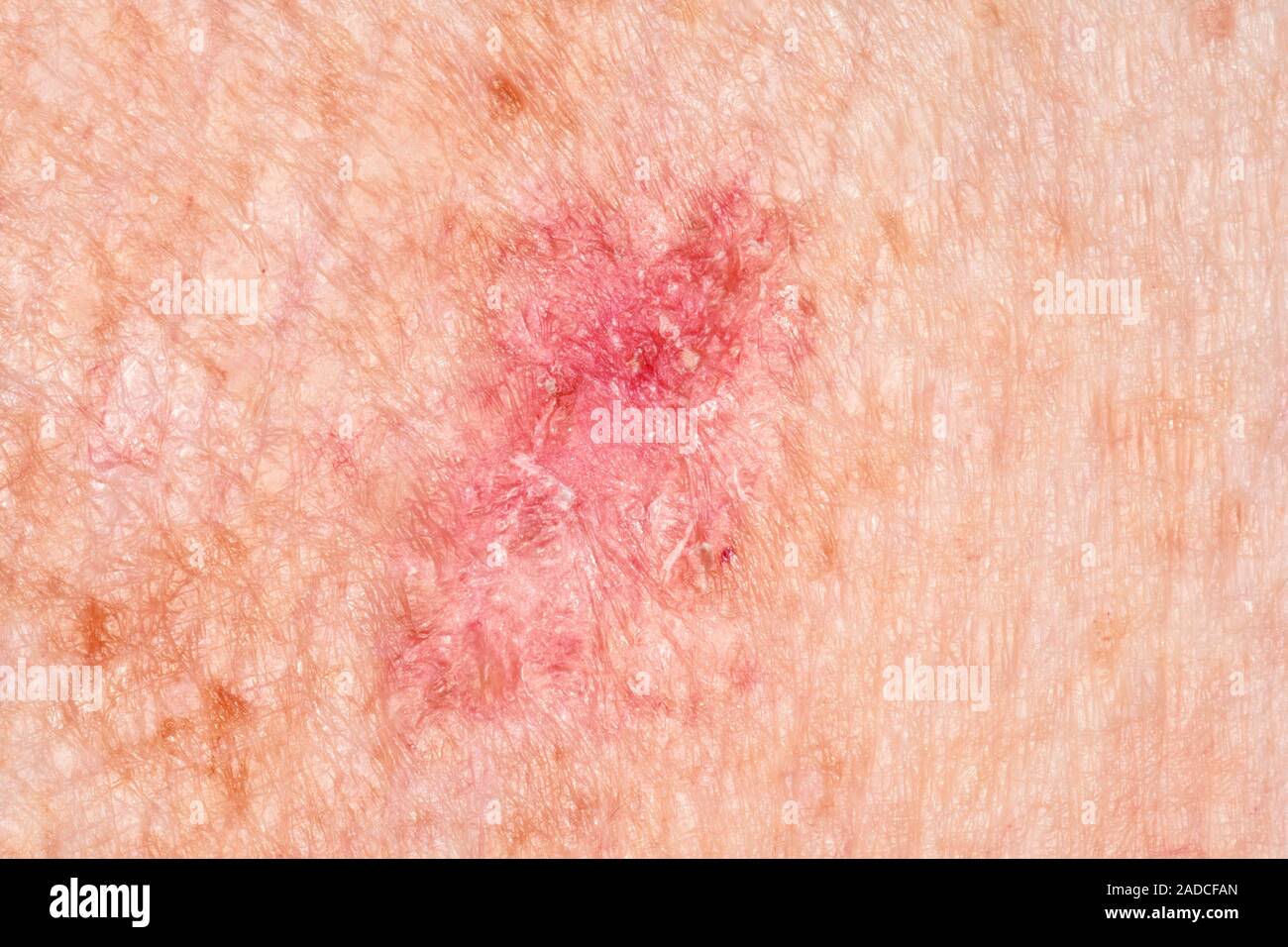 Basal cell carcinoma skin cancer. Close-up of a superficial spreading ...