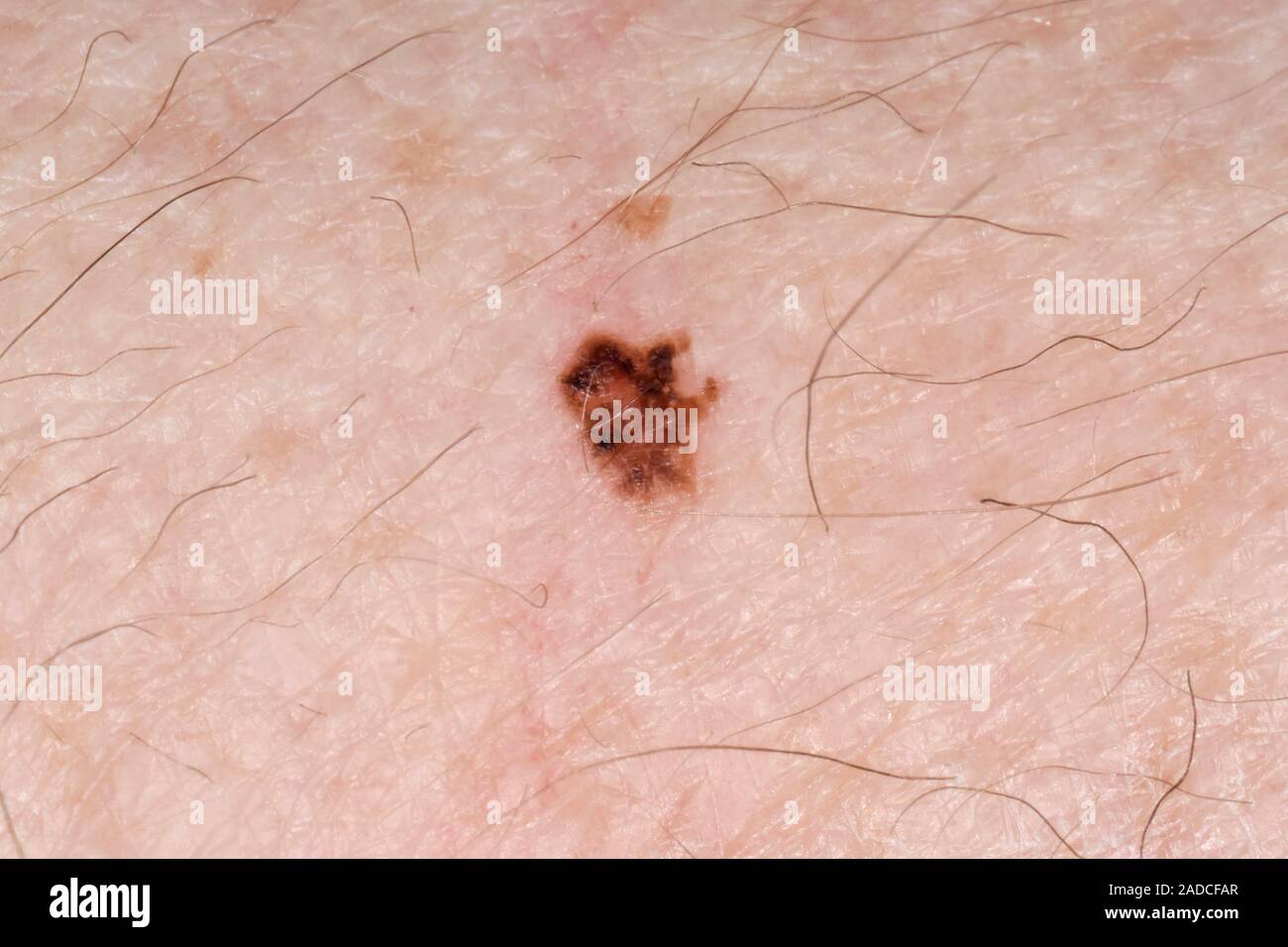Precancerous skin lesion. Close-up of melanocytic intraepithelial ...