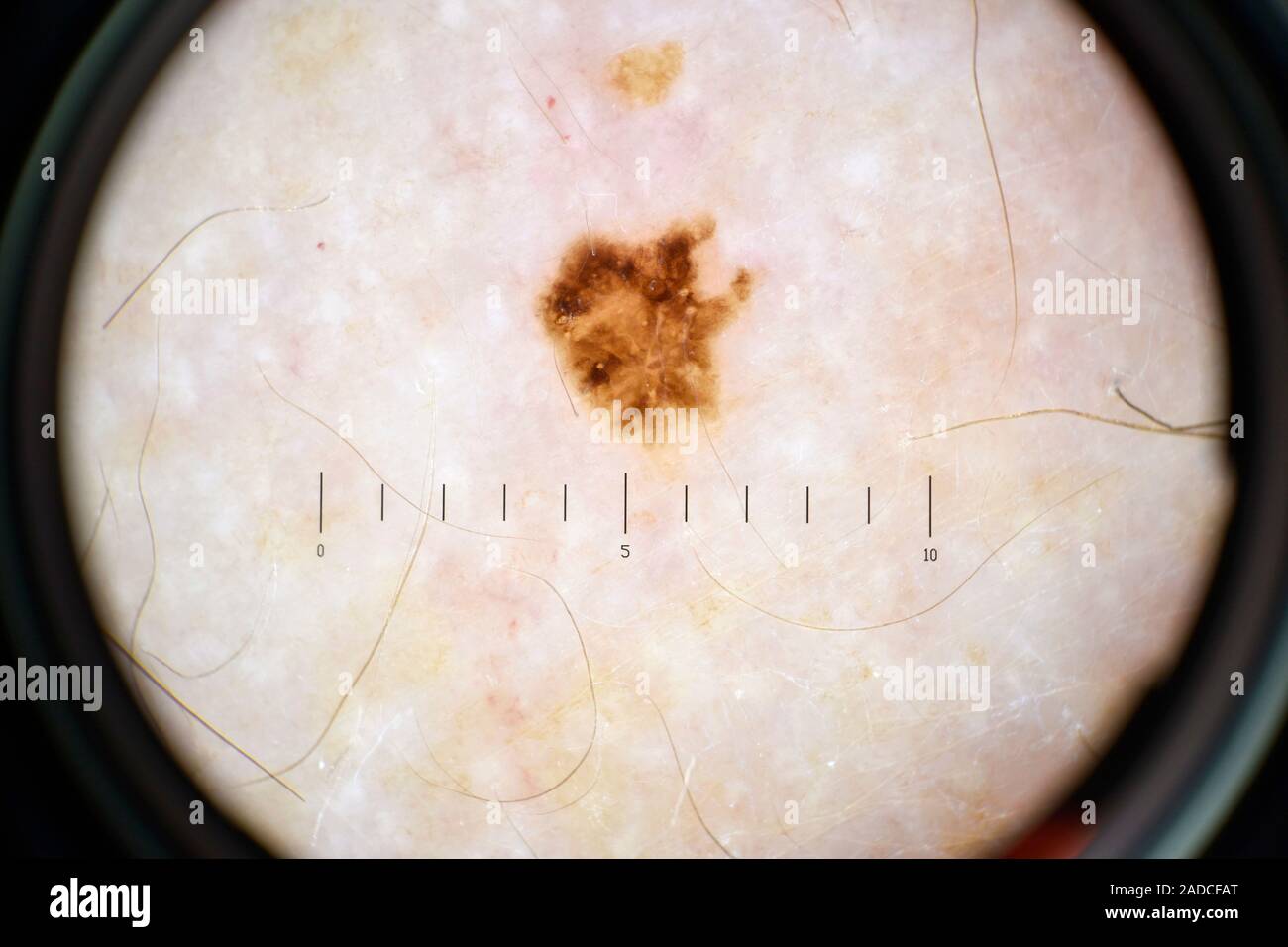 Precancerous skin lesion. Close-up of melanocytic intraepithelial ...