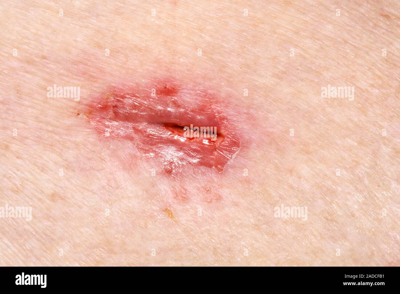 Infected surgical drainage site. Close-up of an infected surgical ...