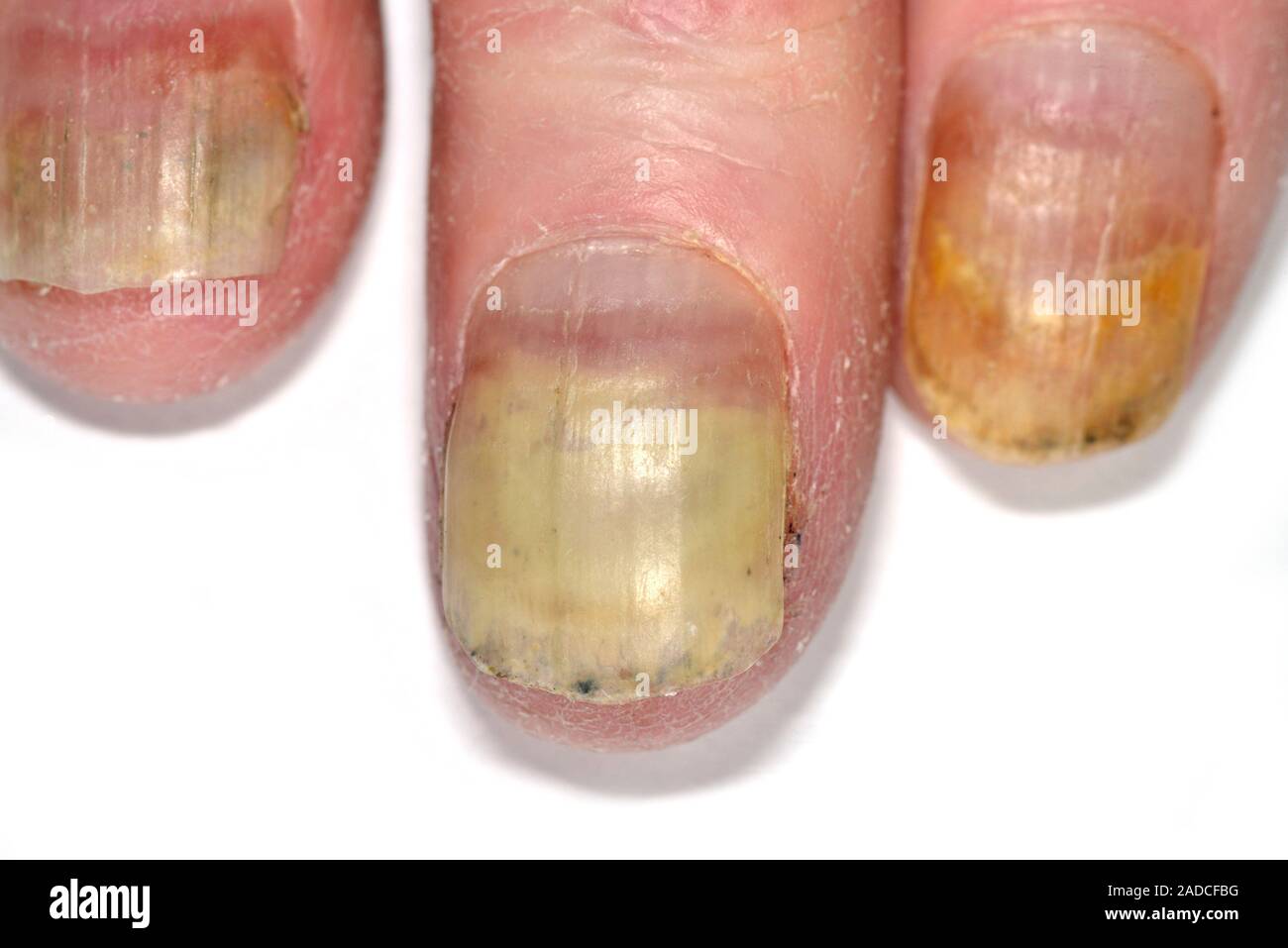 Dystrophic fingernails. Close-up of dystrophy (disrupted growth) of the ...