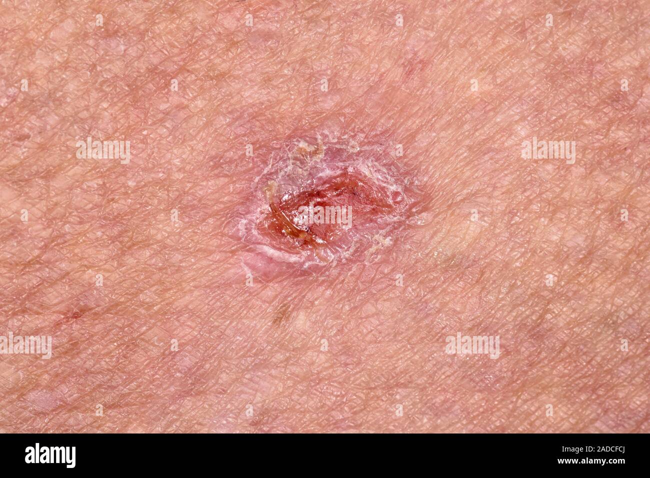 Basal cell carcinoma skin cancer. Close-up of a basal cell carcinoma ...