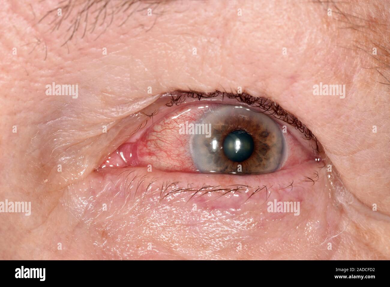 Closed-angle glaucoma. Close-up of the eye of a 79-year-old female ...