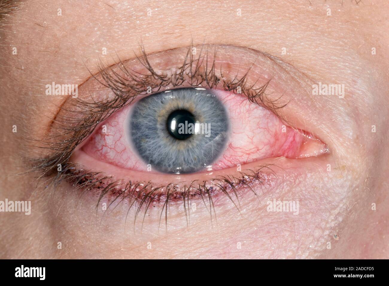 Episcleritis. Close-up of the right eye of a 36-year-old female patient ...