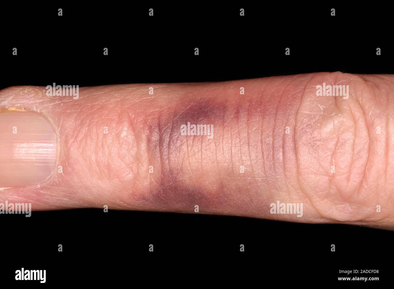 Spontaneous bruising on the finger of a 70-year-old female patient with ...