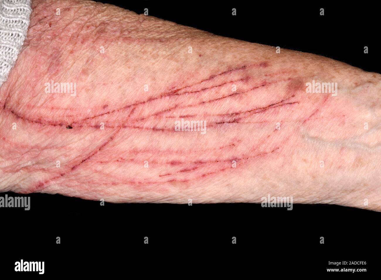 Self harm. Self-inflicted lacerations on the arm of a 91-year-old woman ...