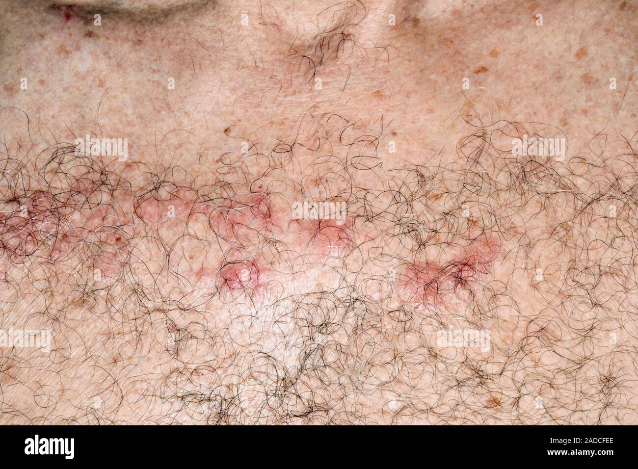 Shingles rash across the chest of a 61-year-old man. Unusually, the ...
