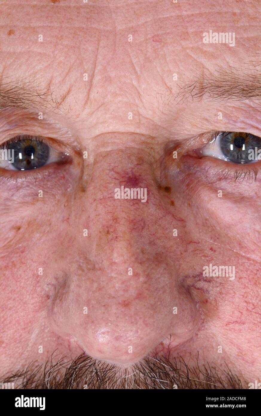 Angioma on the nose of a 50 year old male patient. An angioma is a ...