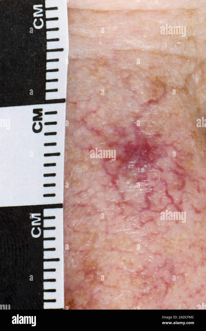 Close-up of an angioma on the nose of a 50 year old male patient. An ...