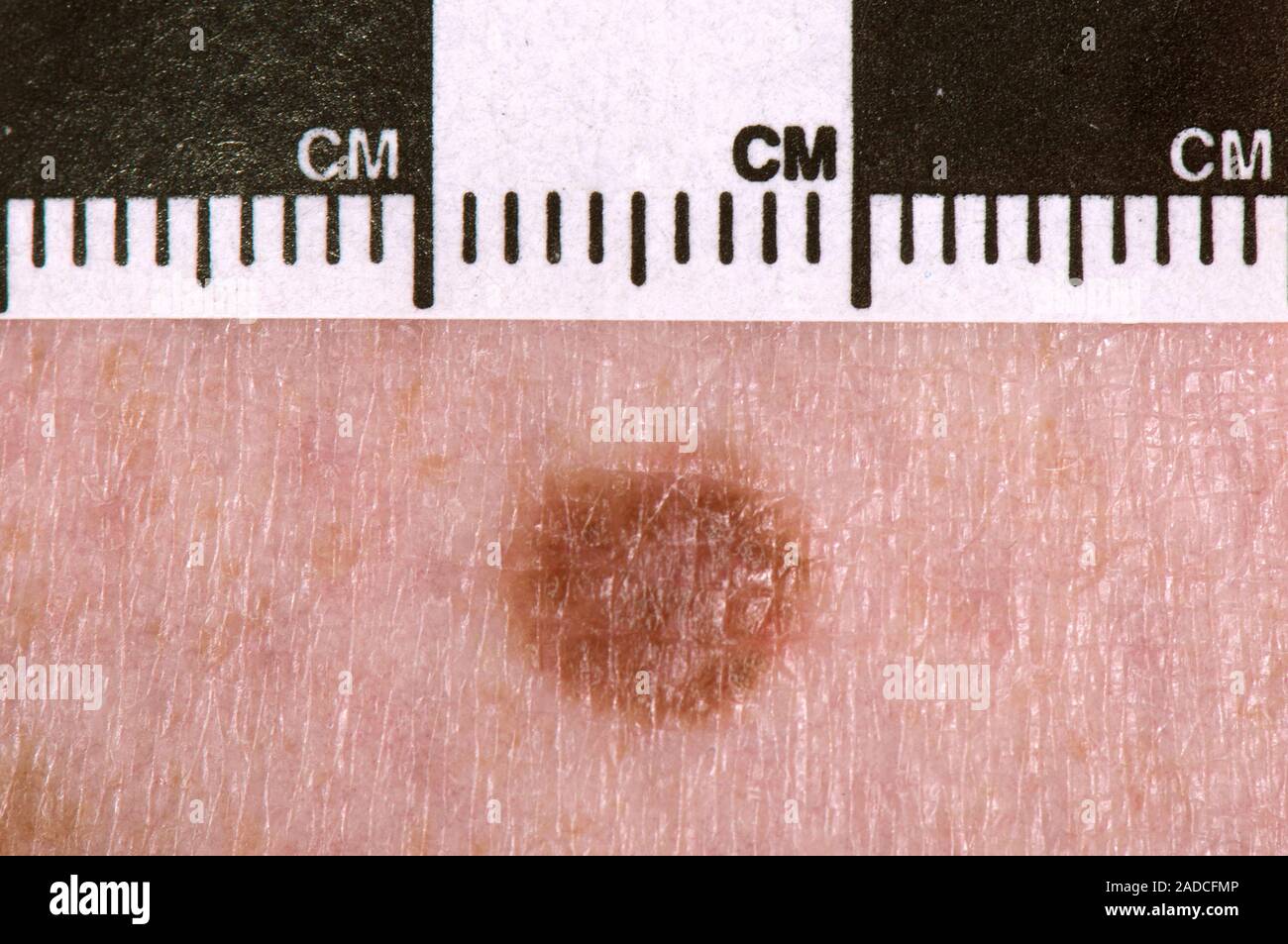 Measurement of an atypical mole on a 57-year-old woman's leg. Atypical ...