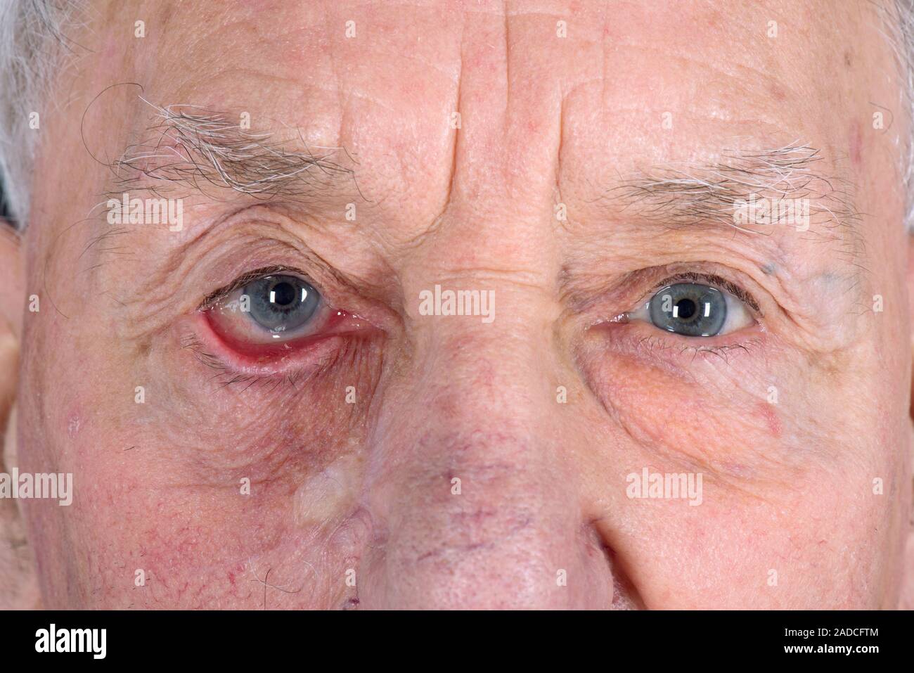 Close-up of the lower eyelid malposition and entropion of the eye of a ...