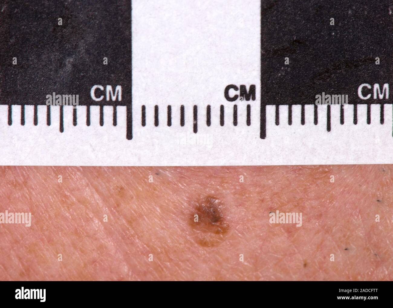 Seborrheic keratosis on the face of a 68 year old male patient. This ...