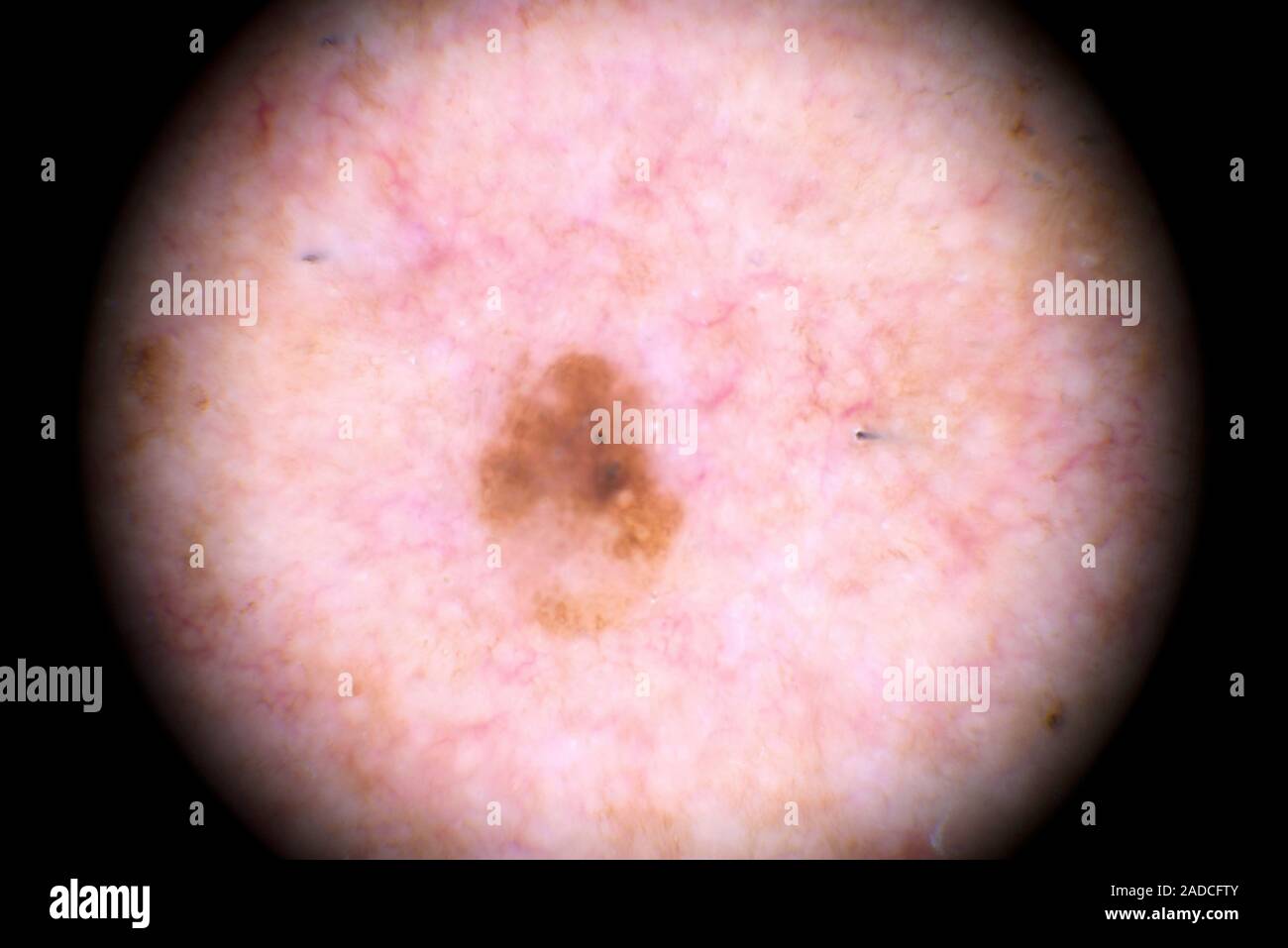 Dermatoscope image of a seborrheic keratosis on the face of a 68 year ...
