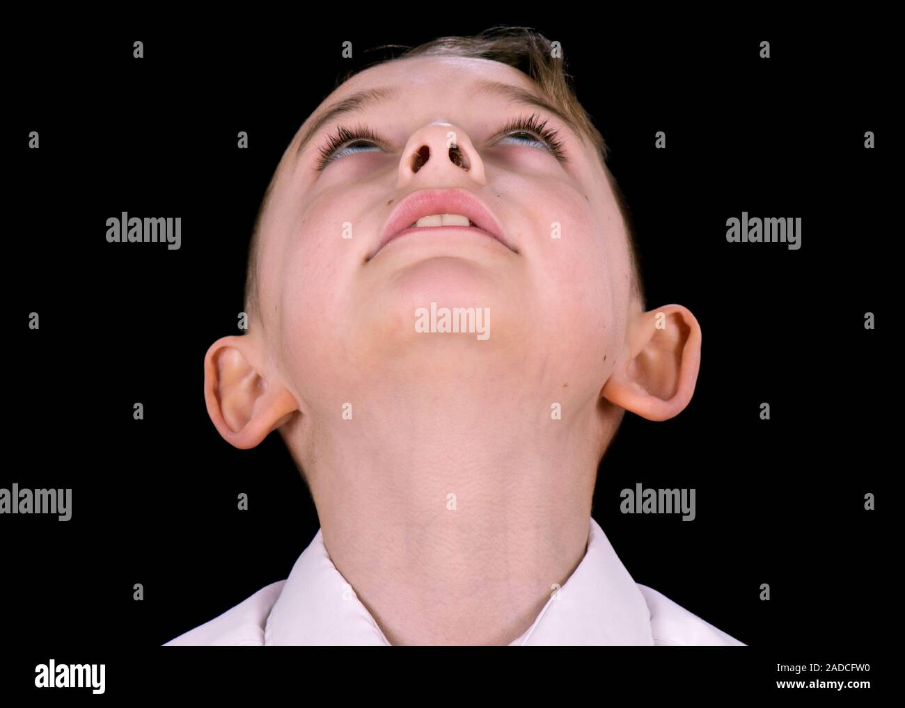 Nine year old boy with prominent ears. Prominent ears are often ...