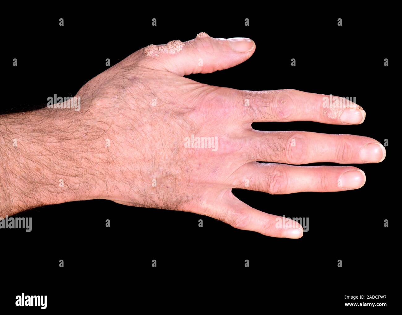 Common warts (verruca vulgaris) on the hand of a 46 year old male ...