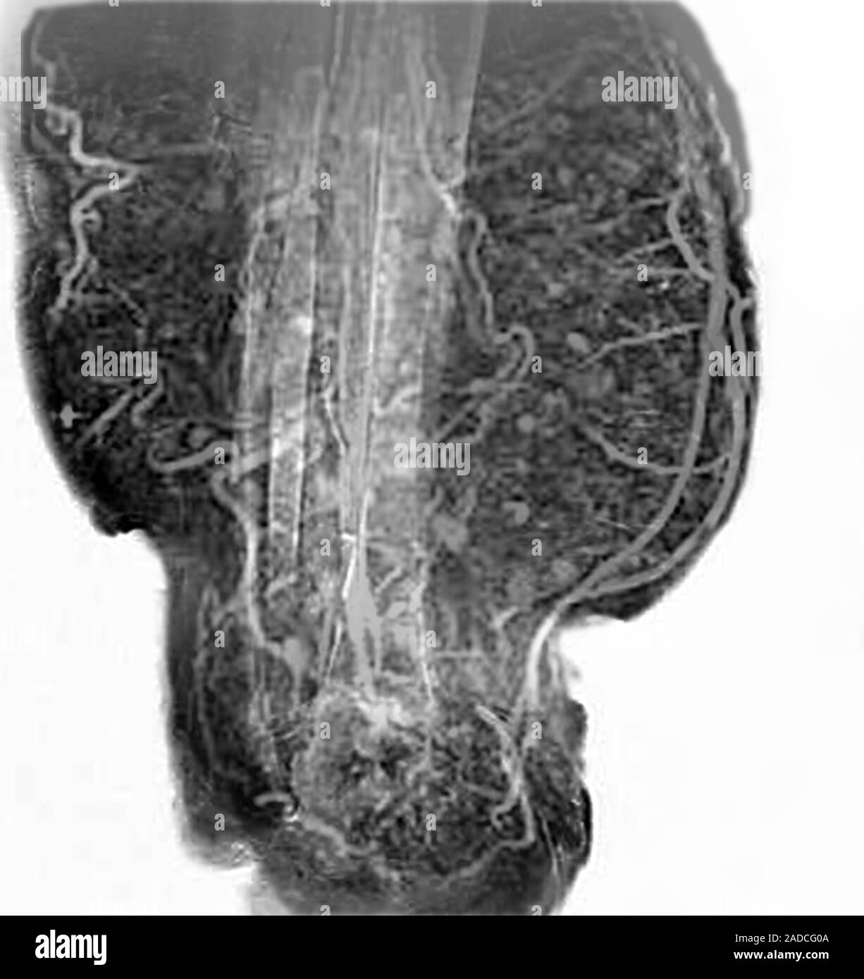 Elephantiasis of the legs. Magnetic resonance angiography (MRA) scan ...