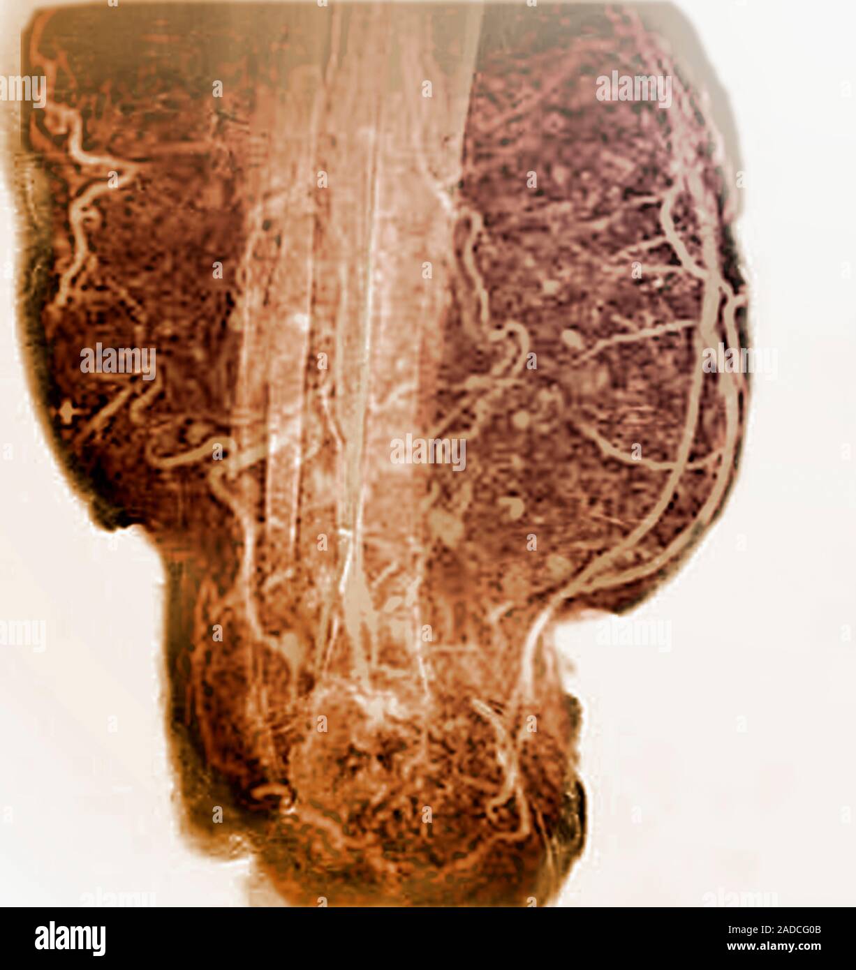 Elephantiasis of the legs. Coloured magnetic resonance angiography (MRA ...