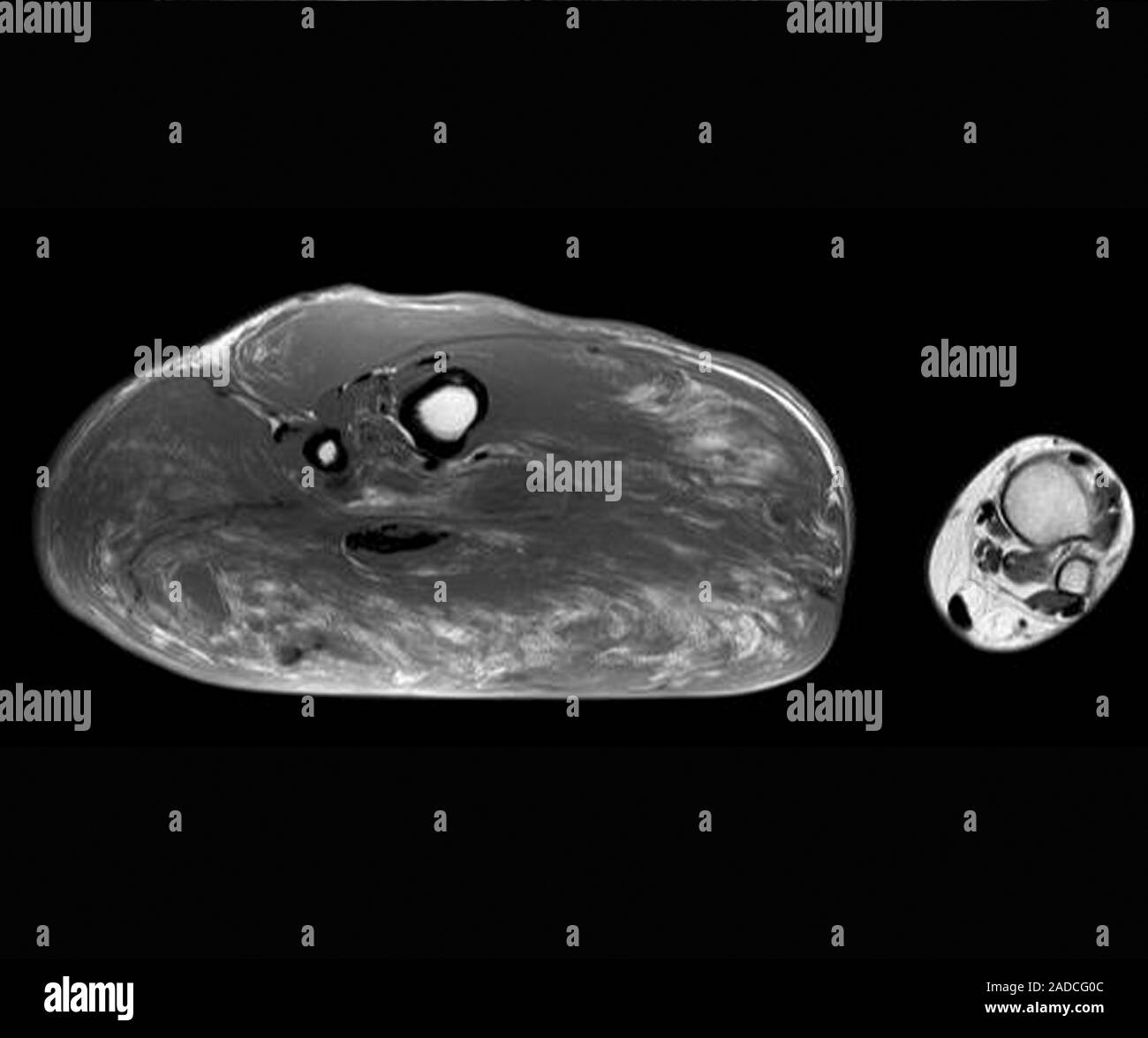 Elephantiasis of the legs. Bilateral axial magnetic resonance imaging ...