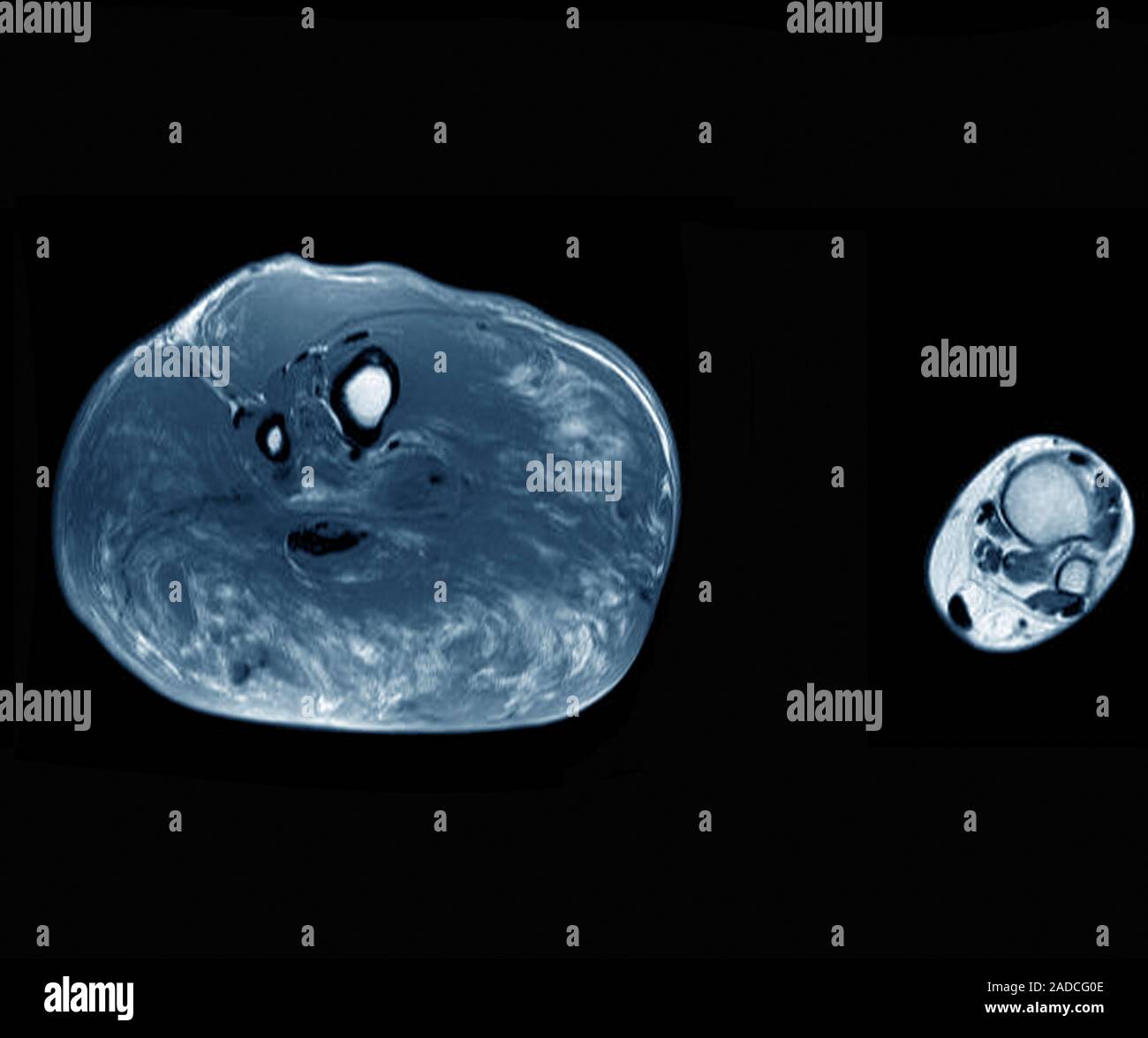 Elephantiasis of the legs. Coloured bilateral axial magnetic resonance ...