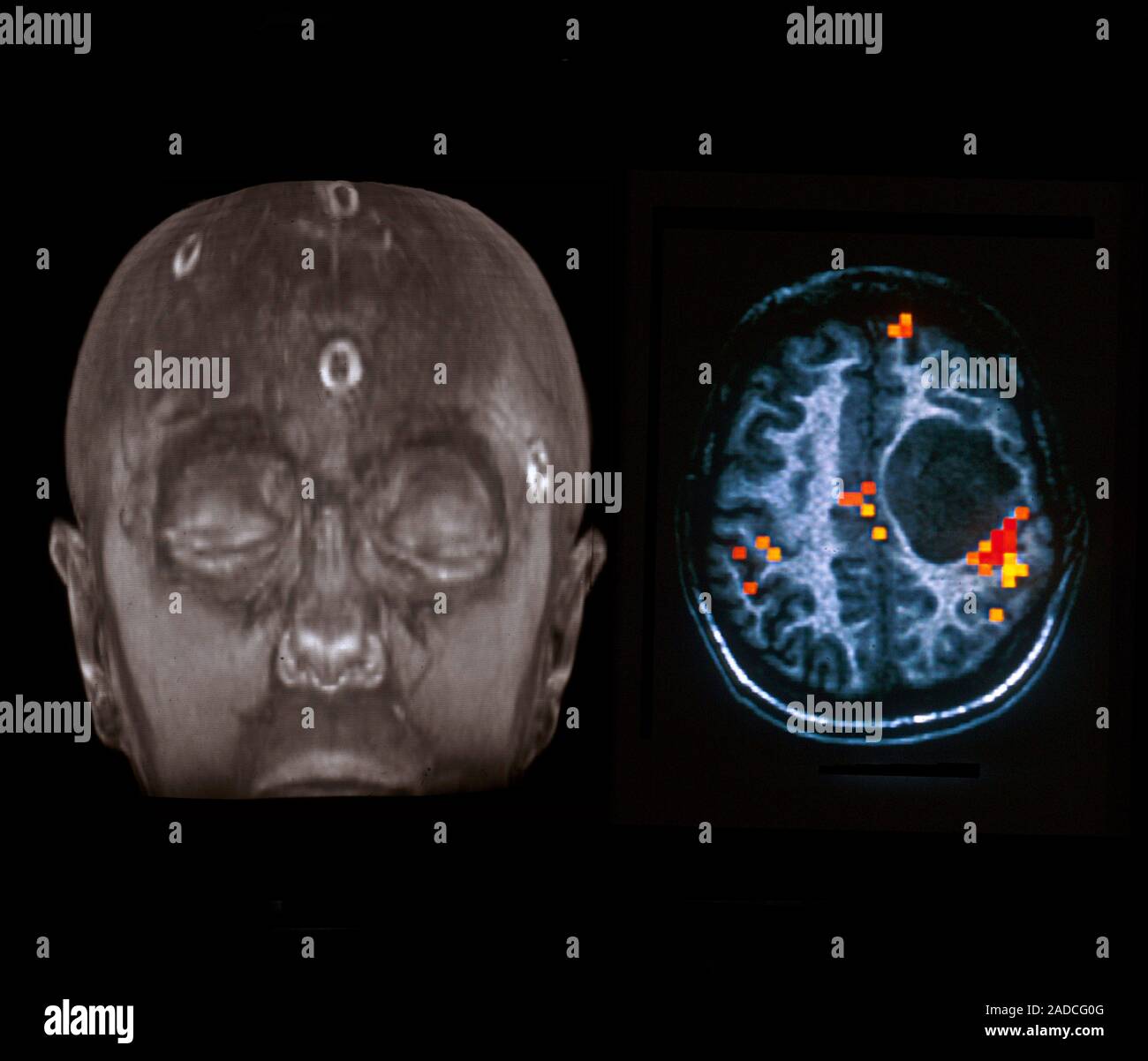 Brain lesion. Coloured 3D and 2D magnetic resonance imaging (MRI) scans of the head and brain of ...