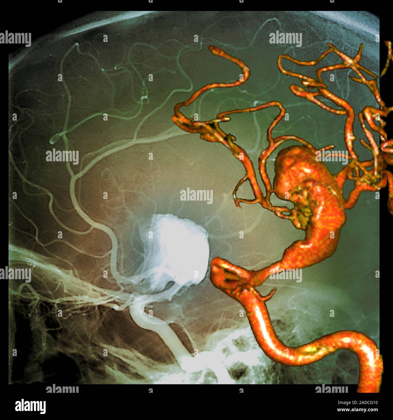 Cerebral aneurysm. Coloured angiogram (blood vessel X-ray) of the brain ...