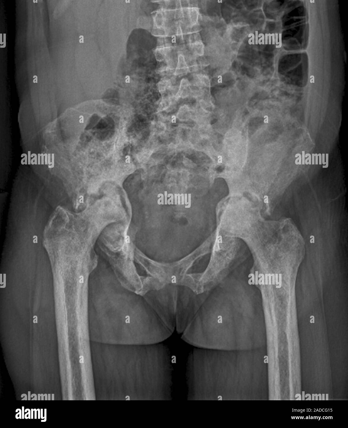 Osteonecrosis of the hip. Frontal X-ray of the pelvic region of a 47 ...