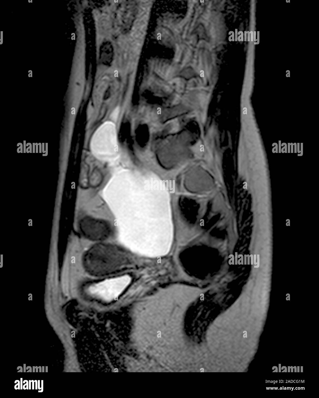 Hydrosalpinx. Sagittal magnetic resonance imaging (MRI) scan of the ...