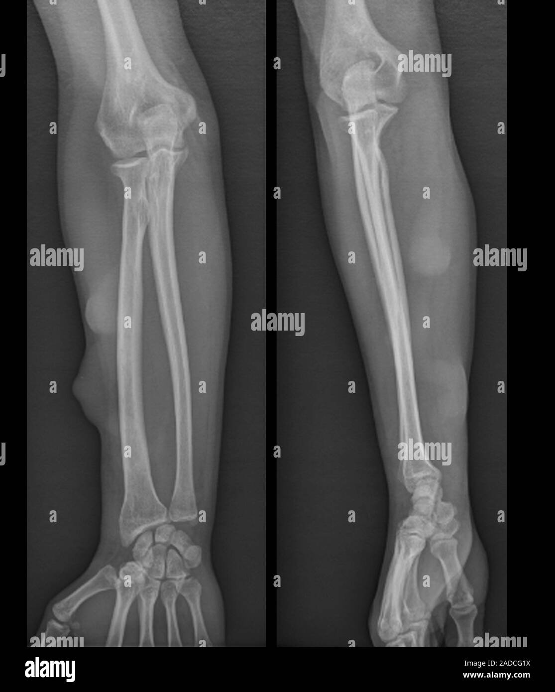 Subcutaneous lipomas on the arm. Frontal (left) and lateral (right) X ...